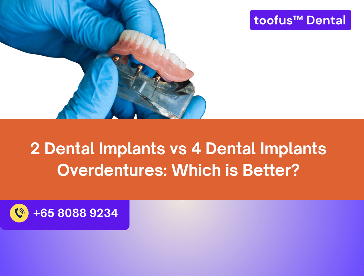 2 vs 4 Dental Implants Overdentures: Which is Better | toofus™ Dental
