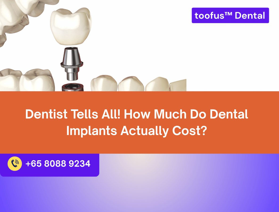Dentist Tells All! How Much Do Dental Implants Actually Cost? | toofus ...